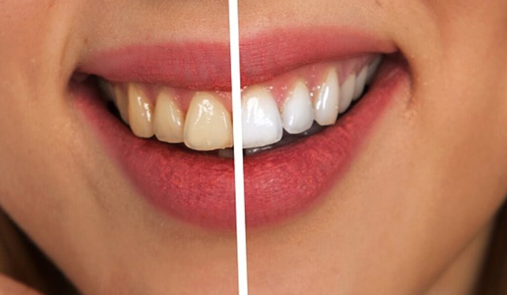 6 Causes of Yellow Teeth Stains | LAVYON